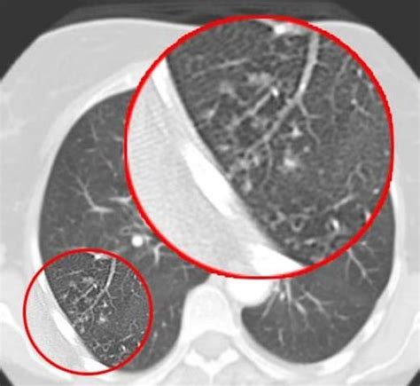 AYAT Blog Tree In Bud Sign Lung