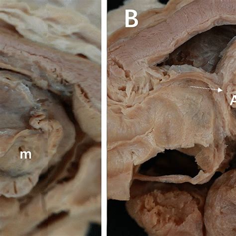 Fiber Dissection From The Medial Side Of Right Hemisphere A The