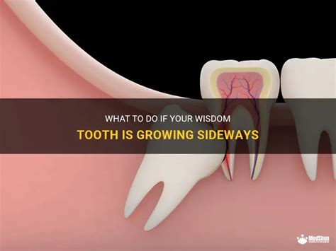What To Do If Your Wisdom Tooth Is Growing Sideways Medshun