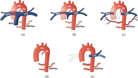 Diagram Demonstrates 5 Cta Types 11 Subtypes Of Pulmonary