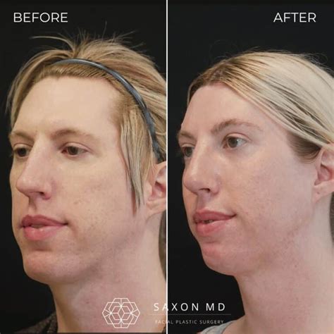 Facial Feminization Surgery Before And After Photos Ffs Austin