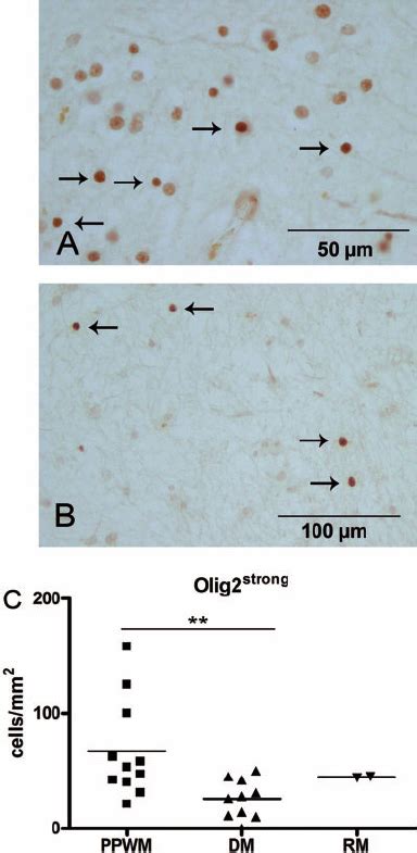 Progenitor Cells In Chronic Multiple Sclerosis Lesions Olig2 Strong Download Scientific