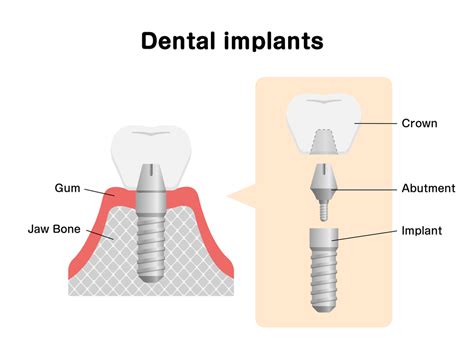 How To Replace A Missing Tooth Annex Dentistry