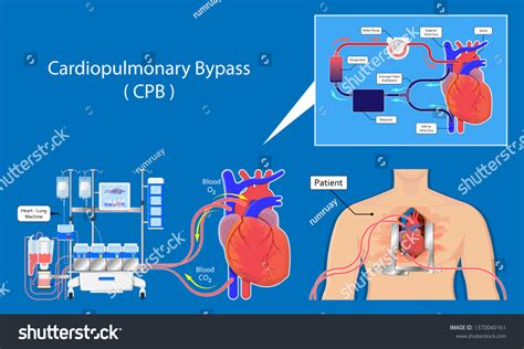 Cardiopulmonary Bypass Heart Lung Machine Coronary Stock Vector
