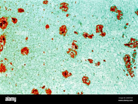 Alzheimers Disease Coloured Light Micrograph Of Tissue From The