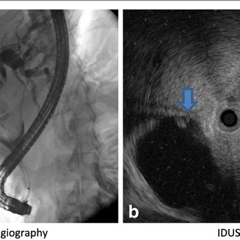 A Cholangiogram Shows A Large Oval Shaped Filling Defect Arrow In The Download Scientific