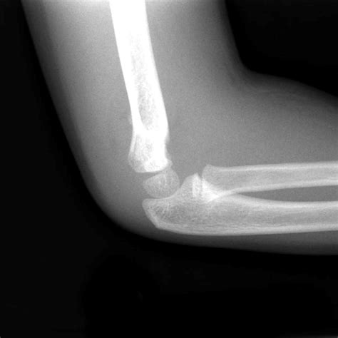 Paediatric Upper Limb Fractures Critical Care Collaborative