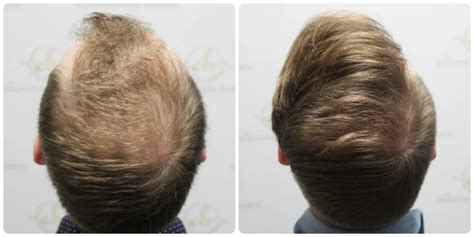 Hair Shedding After A Hair Transplant Causes And Timeline
