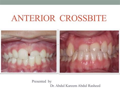 Anterior Crossbite Pptx