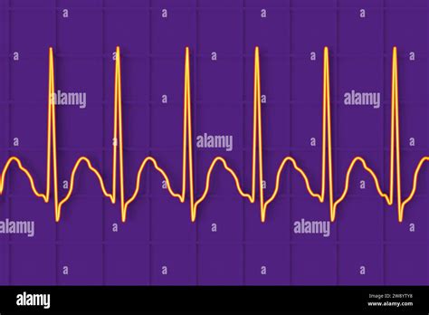 Illustration Depicting An Atrial Flutter Abnormal Heart Rhythm On An