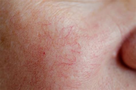 Facial Spider Vein Clearance What To Expect During And After