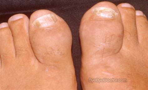 Symptoms Causes Treatment Of Disease Dactylitis Symptoms Causes Treatment Pictures