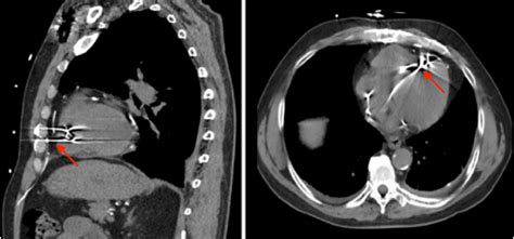A Shocking Case Of Pacemaker Lead Perforation Jacc Case Reports