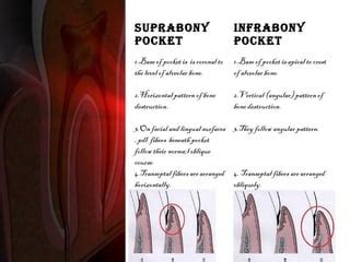 Periodontal Pockets Ppt