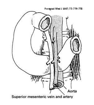Duodenal Obstruction Syndrome Compression Of The Lower Horizontal Part Download Scientific