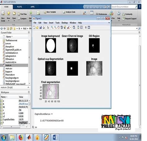Glaucoma Detection From Fundus Images Using Matlab Gui Myprojectbazaar
