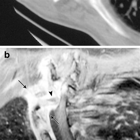 Case 4 A Axial Ct Shows Widening Of The Neural Foramina With Download Scientific Diagram