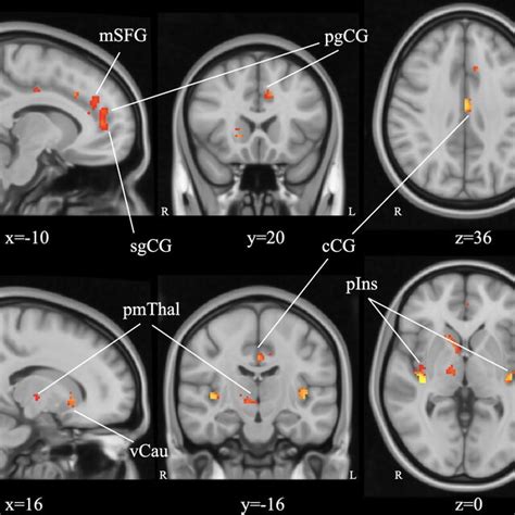 Brain Regions Demonstrating Decreased Functional Connectivity With Pag Download Scientific
