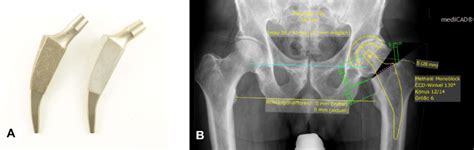 Metha ® Hip Stem 130° Left 120° Right A Digital Templating Download Scientific Diagram