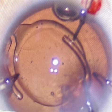 After The Capsular Tension Ring Was Implanted A Single Piece Foldable Download Scientific