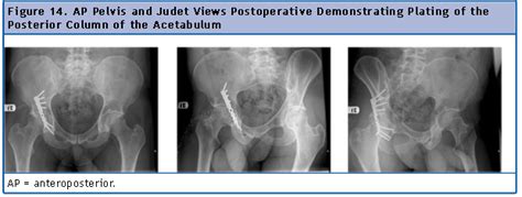 Imaging Pelvic Fractures Eradimagingcom Rt Ce