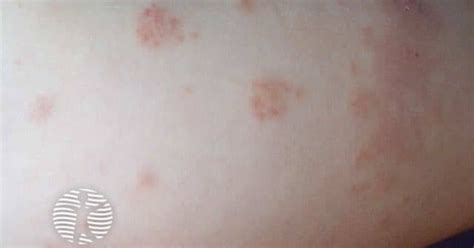 Nummular Dermatitis Discoid Eczema Image