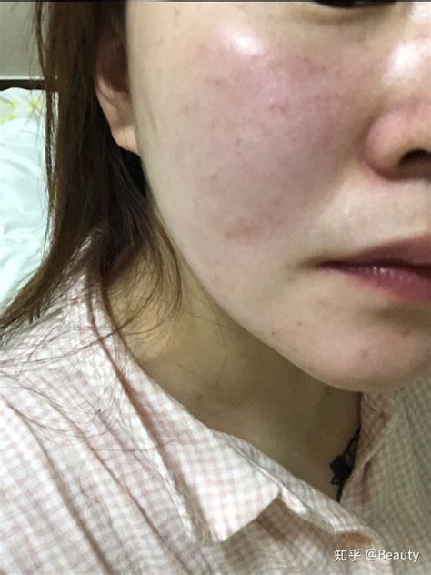 日光性皮炎敏感肌肤过敏体质「续命大法」上篇 知乎