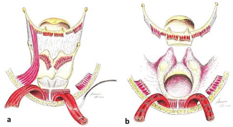 Sternohyoid Muscles Isolated And Detached From The Hyoid Bone Fashioned