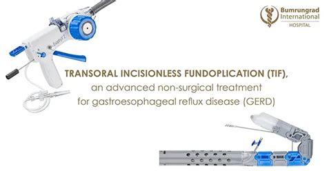 Transoral Incisionless Fundoplication Tif An Advanced Non Surgical