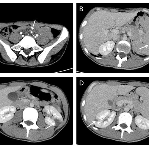 Complications Of Abiotrophia Defectiva Infective Endocarditis A