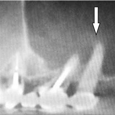 Alveolar Antral Artery In The Lateral Maxillary Sinus Wall Download