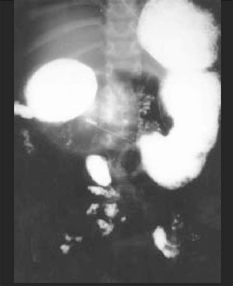 Upper Gastrointestinal Study Showing A Dilated Duodenum That Is