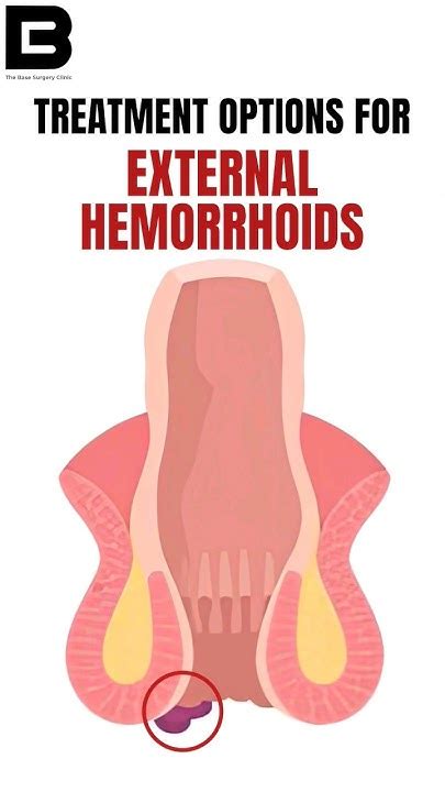 What Are The Surgical Treatment Options For External Hemorrhoids