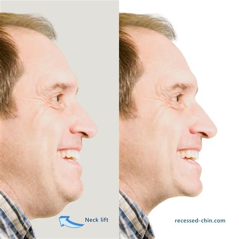 Neck Lift Surgical Before And After Simulator