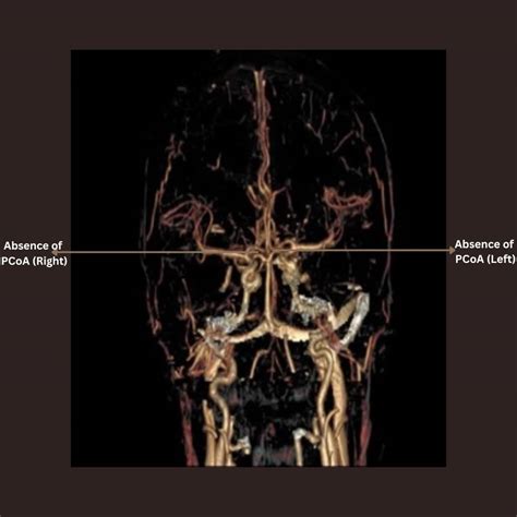 Circle Of Willis Mri
