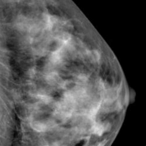 The Four Breast Parenchymal Patterns Notes A Fatty B Scattered