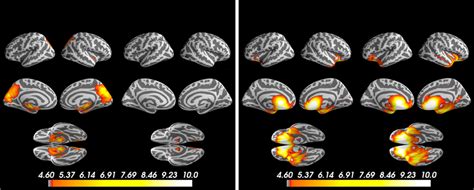 Dynamic Statistical Parametric Map Dspm At Two Different Time Points Download Scientific