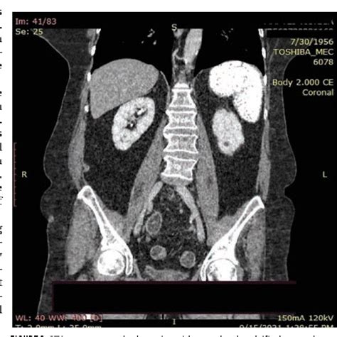 Pdf Total Spleen Calcification A Rare Clinical Manifestation In