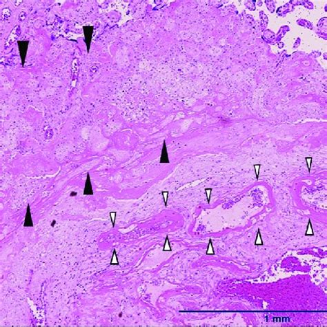 The Microscopic Findings Of The Decidua Of The Non Placental Site