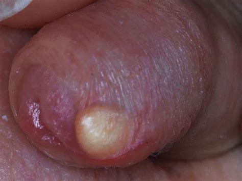 Smegmal Cyst Mr Andrew Robb