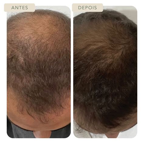 Terapia Capilar Botoclinic