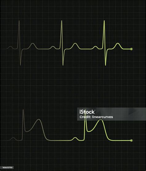 Gelombang Ekg Normal Dan Abnormal Ilustrasi Stok Unduh Gambar