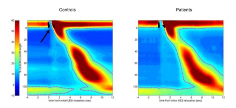 Symptomatic Patients With “normal” Esophageal Manometry Manometry