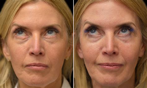 Description Bilateral Upper And Lower Blepharoplasty Septal Window