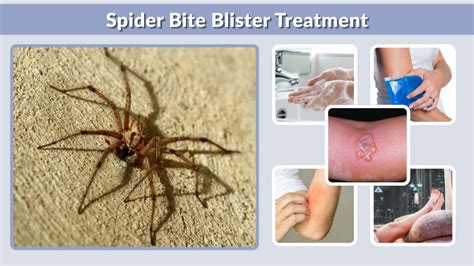 Spider Bite Blister Causes Symptoms And Treatment Guide