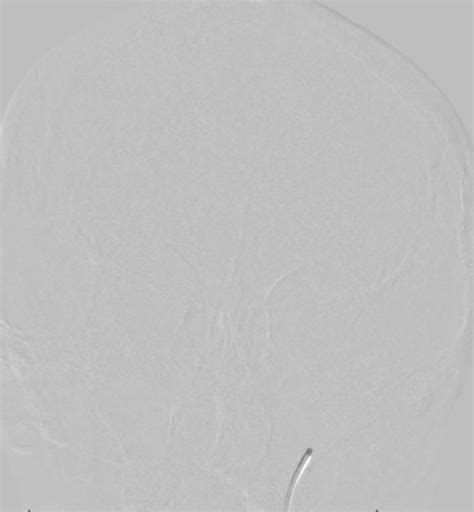 Video Bharathi Jagadeesan On Linkedin Medtronic Pipelinedevice