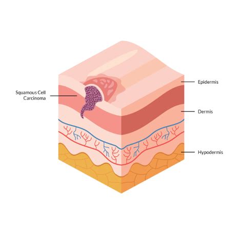 Dr Becker Skin Cancer Care Squamous Cell Carcinoma Care Near Black