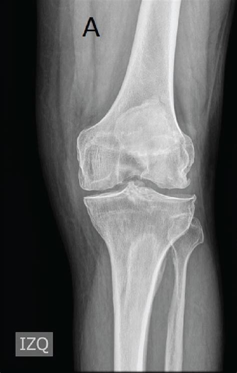 Preoperative Radiographs Show Severe Tricompartmental Left Knee