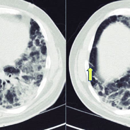 High Resolution CT Scan Of The Chest Demonstrating Traction Download Scientific Diagram