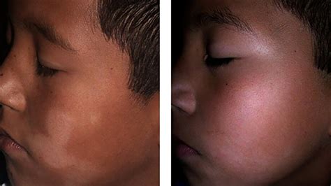 Pityriasis Versicolor Causes Symptoms Treatment